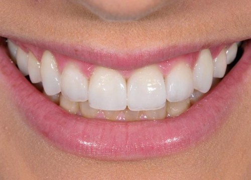 Smile Gallery - Veritas Dental Care