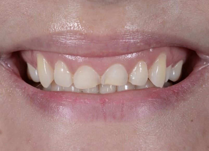 Smile Gallery - Veritas Dental Care